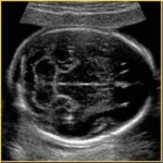 Fetal Central Nervous System: Development and Normal Ultrasound of the ...