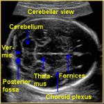 Fetal Central Nervous System: Development and Normal Ultrasound of the ...