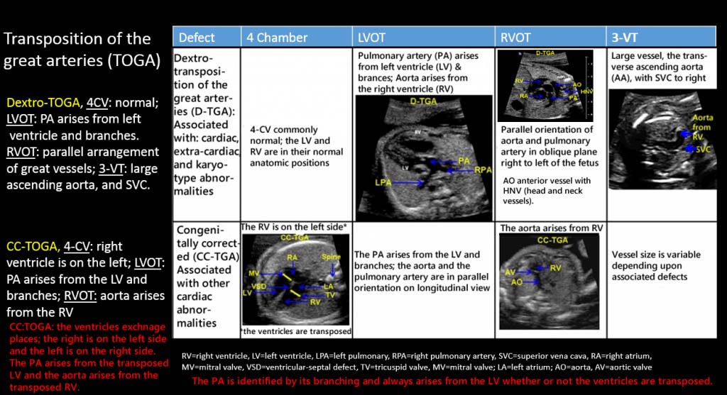 Congenitally Corrected Transposition of the Great Arteries (CC-TGA)